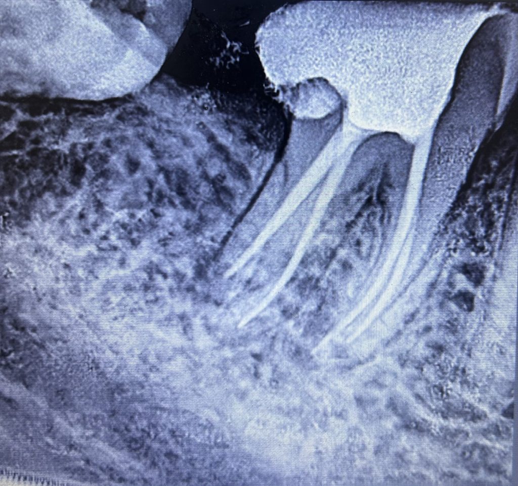 Saving a Severely Infected Tooth – The Story of a Pain-Free Future - Dr ...